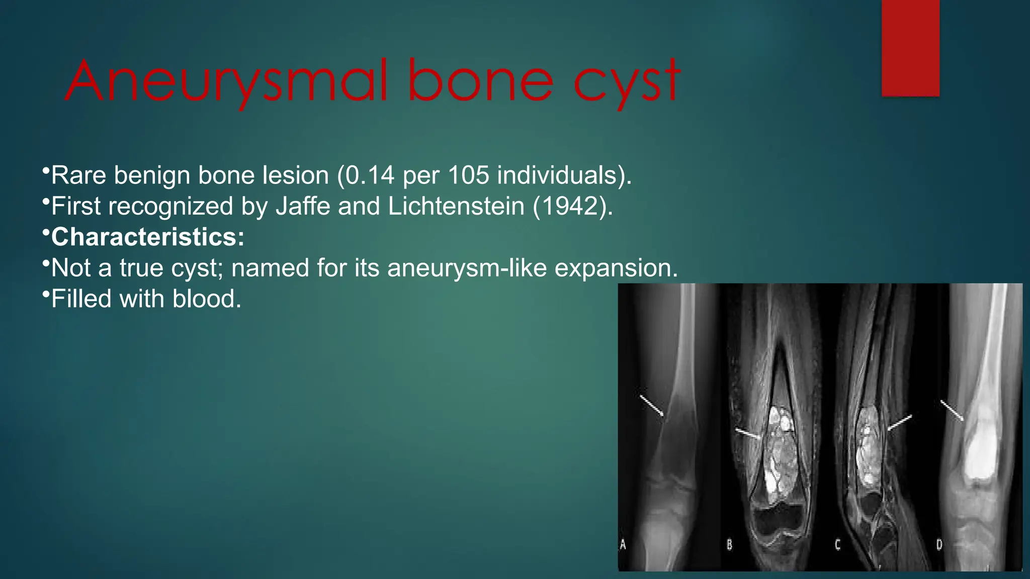 Bone tumors-fibrous dysplasia,simple bone cyst,aneurysmal bone cyst | PPT