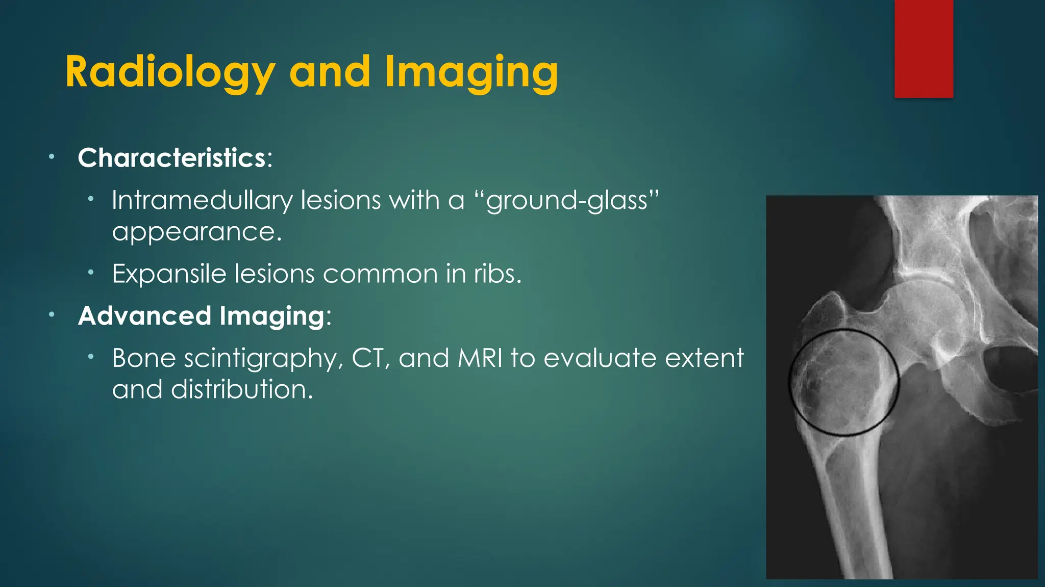 Bone tumors-fibrous dysplasia,simple bone cyst,aneurysmal bone cyst | PPT