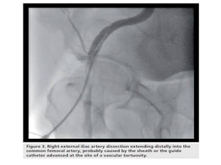Femoral artery catheterisation and complications | PPTX
