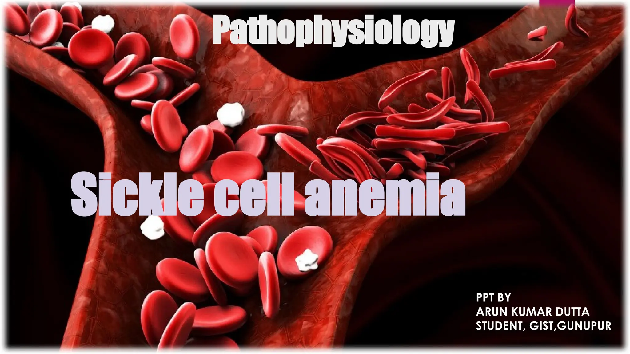 sickle cell anemia ppt by arun kumar dutta.pptx