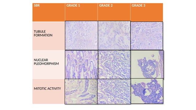 Presentation on breast cancer IHC markers | PPT