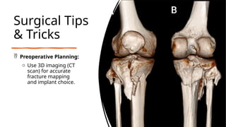 Proximal tibia fracture Nailing combined with plating.pptx