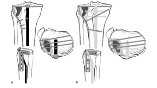 Proximal tibia fracture Nailing combined with plating.pptx