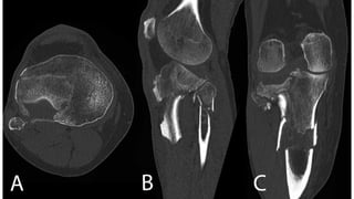 Proximal tibia fracture Nailing combined with plating.pptx