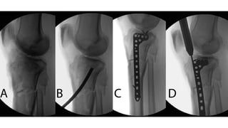 Proximal tibia fracture Nailing combined with plating.pptx