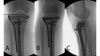 Proximal tibia fracture Nailing combined with plating.pptx