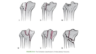 Proximal tibia fracture Nailing combined with plating.pptx