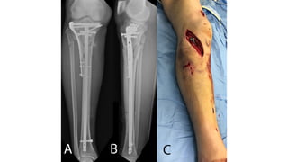 Proximal tibia fracture Nailing combined with plating.pptx