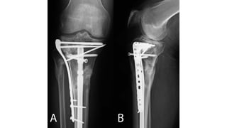Proximal tibia fracture Nailing combined with plating.pptx