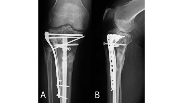 Proximal tibia fracture Nailing combined with plating.pptx