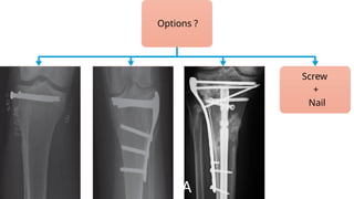 Proximal tibia fracture Nailing combined with plating.pptx