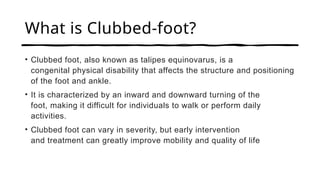 Info on Clubbed foot as a physical disability | PPT