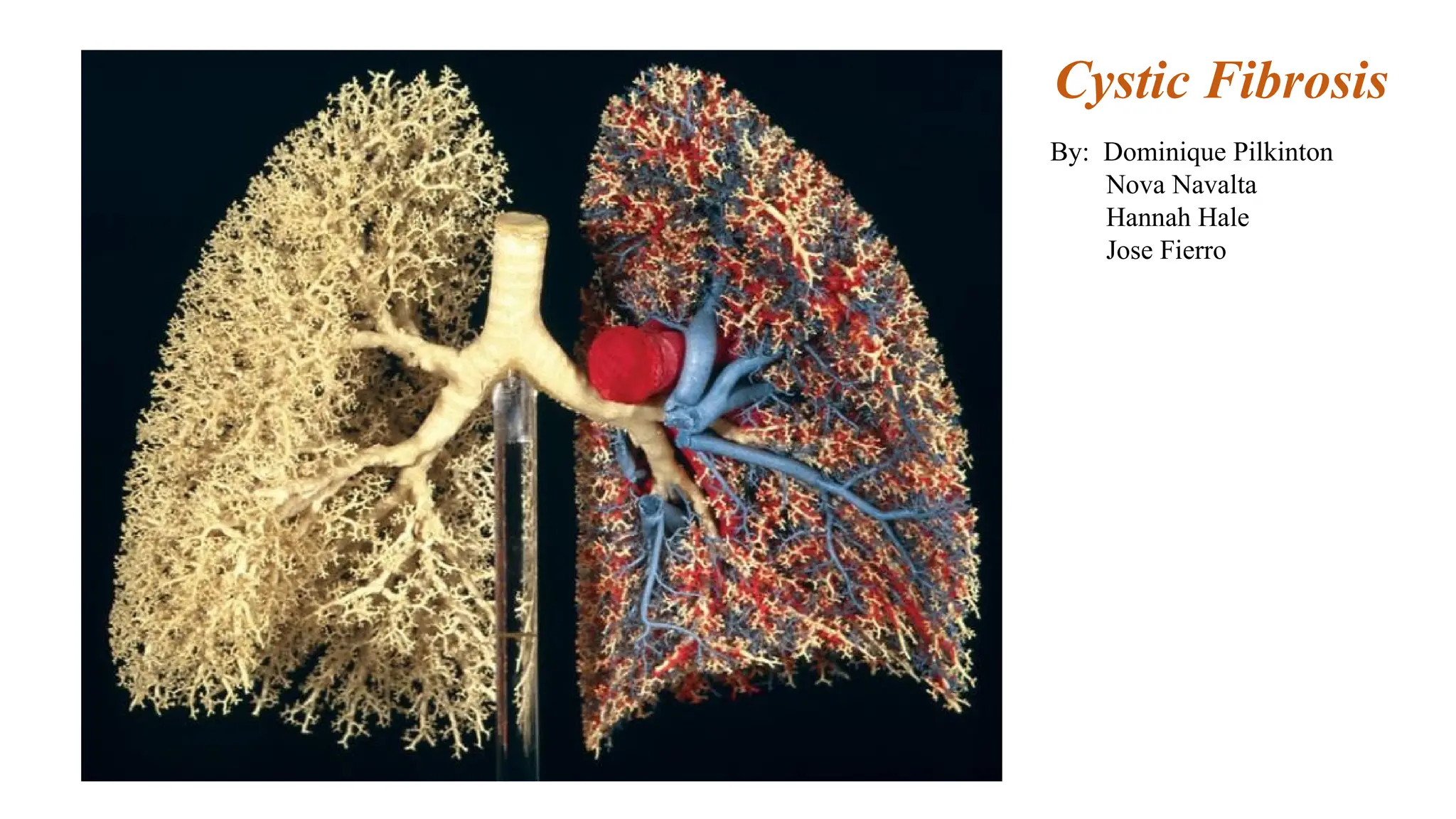 People with CF Signs & Symptoms of Cystic Fibrosis | PPTX