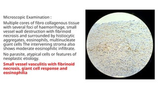 small vessel vasculitis case presentation | PPT