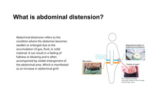Presentation abdominal distension (1).pptx