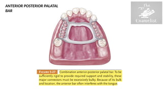 Maxillary major connector (removable partial denture ) | PPTX