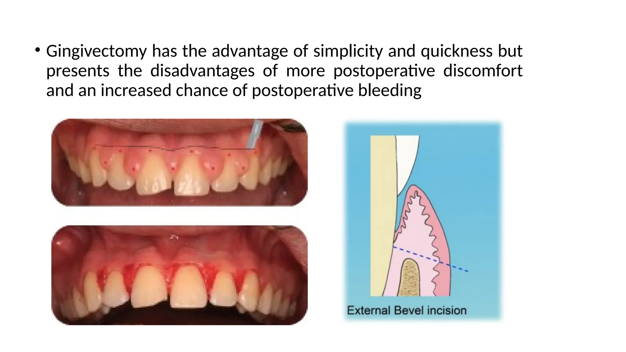 gingivectomy in suprabony periodontal pockets | PPTX