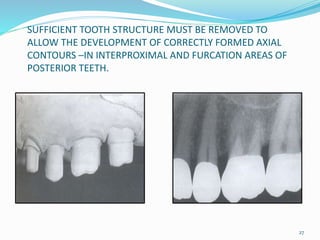 principles of tooth preparations | PPTX