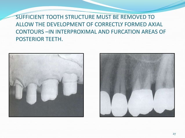 principles of tooth preparations | PPTX | Dental Health | Diseases and ...
