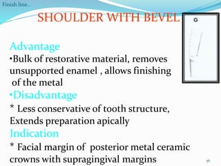 principles of tooth preparations | PPTX