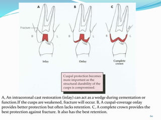 principles of tooth preparations | PPTX
