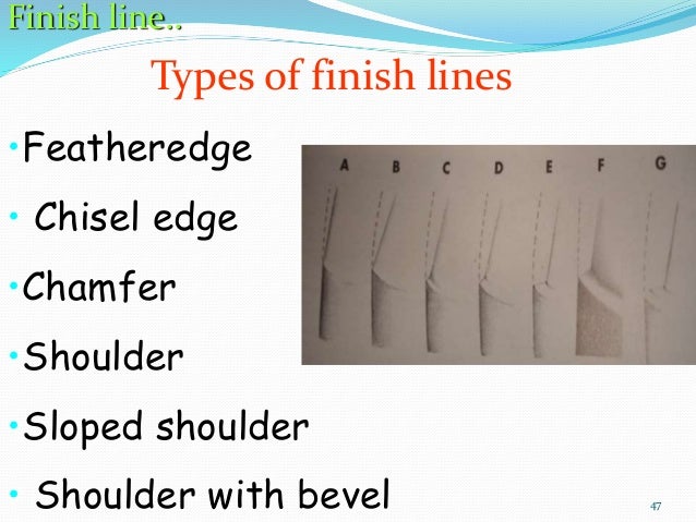 principles of tooth preparations