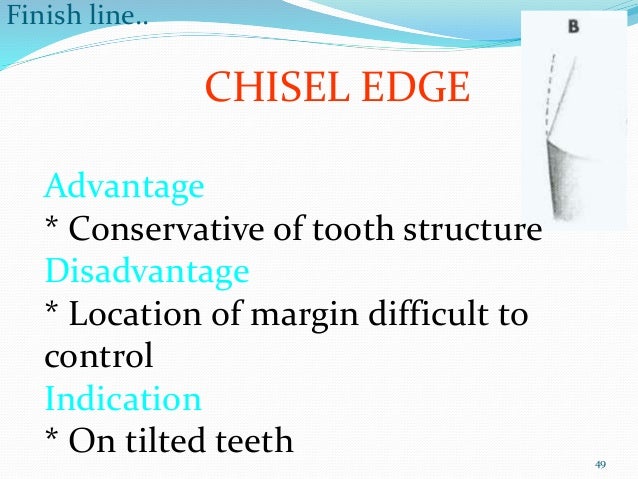 principles of tooth preparations