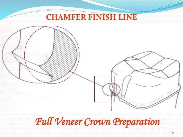 principles of tooth preparations