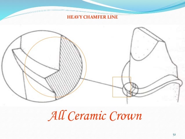 principles of tooth preparations