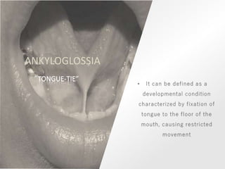 Developmental Disorders of The Tongue | PPTX