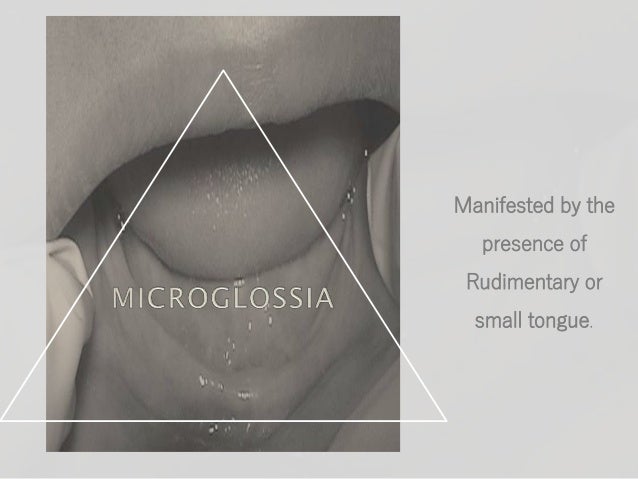 Developmental Disorders of The Tongue