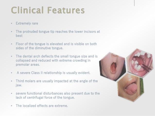Developmental Disorders of The Tongue