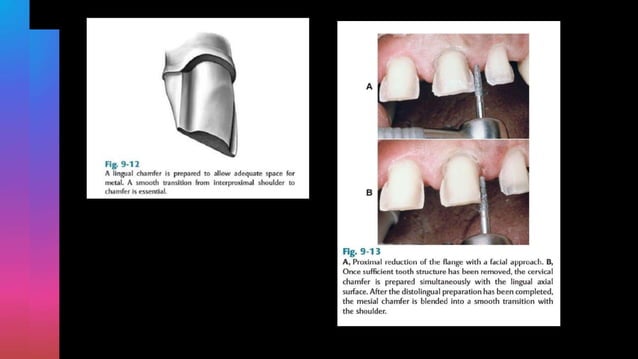 Presentation 10.pptx the metal ceramic crown preparation | PPTX