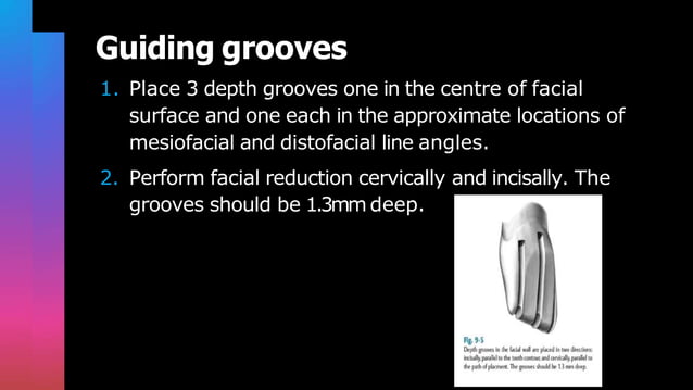 Presentation 10.pptx the metal ceramic crown preparation | PPTX