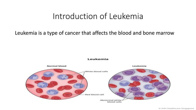 Leaukemia and it cause sign and symptoms | PPT