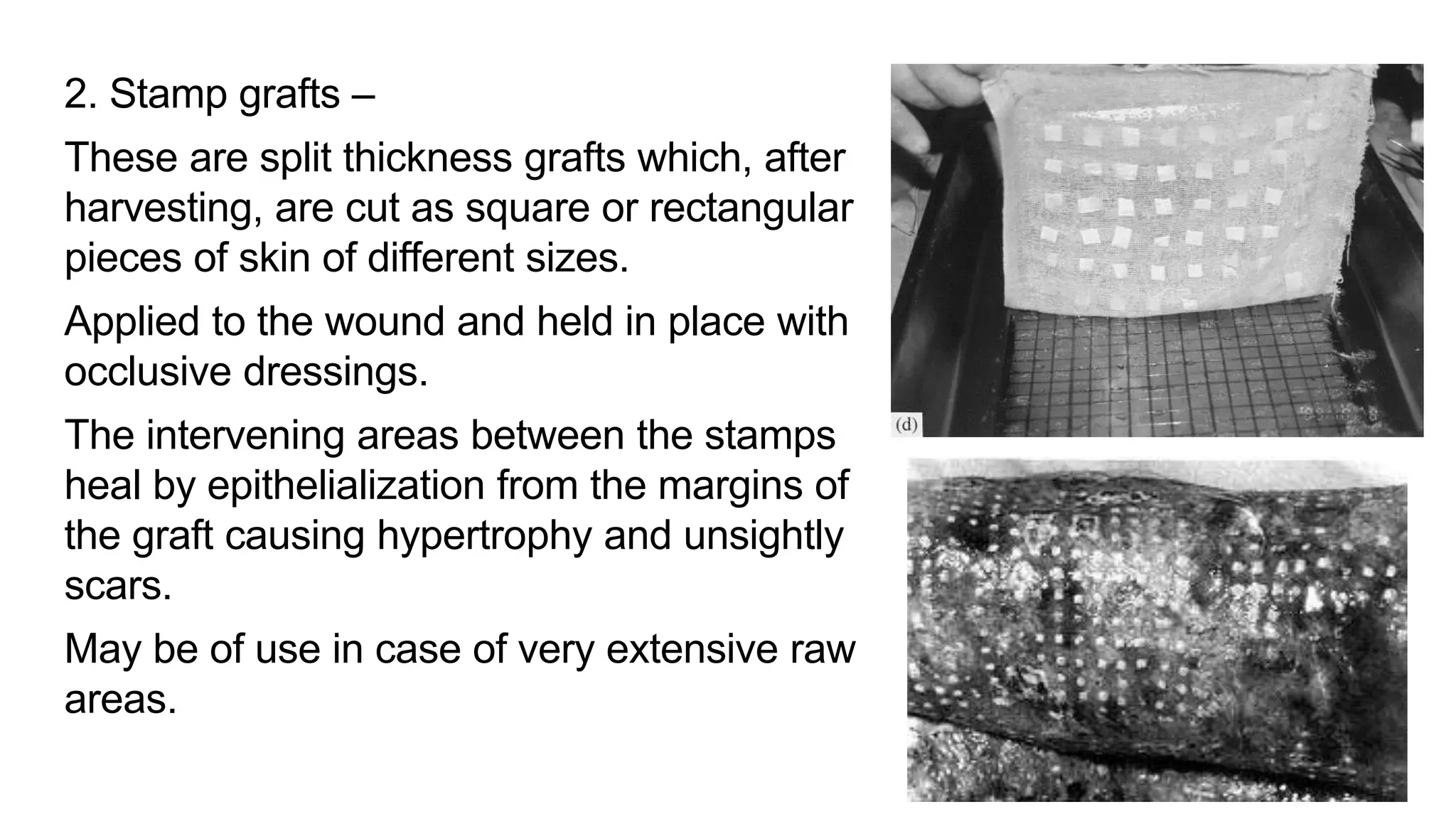 Split thickness skin grafting presentation.pptx