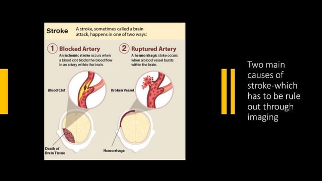 Ischemic stroke imaging | PDF | Brain and Nervous System Disorders ...
