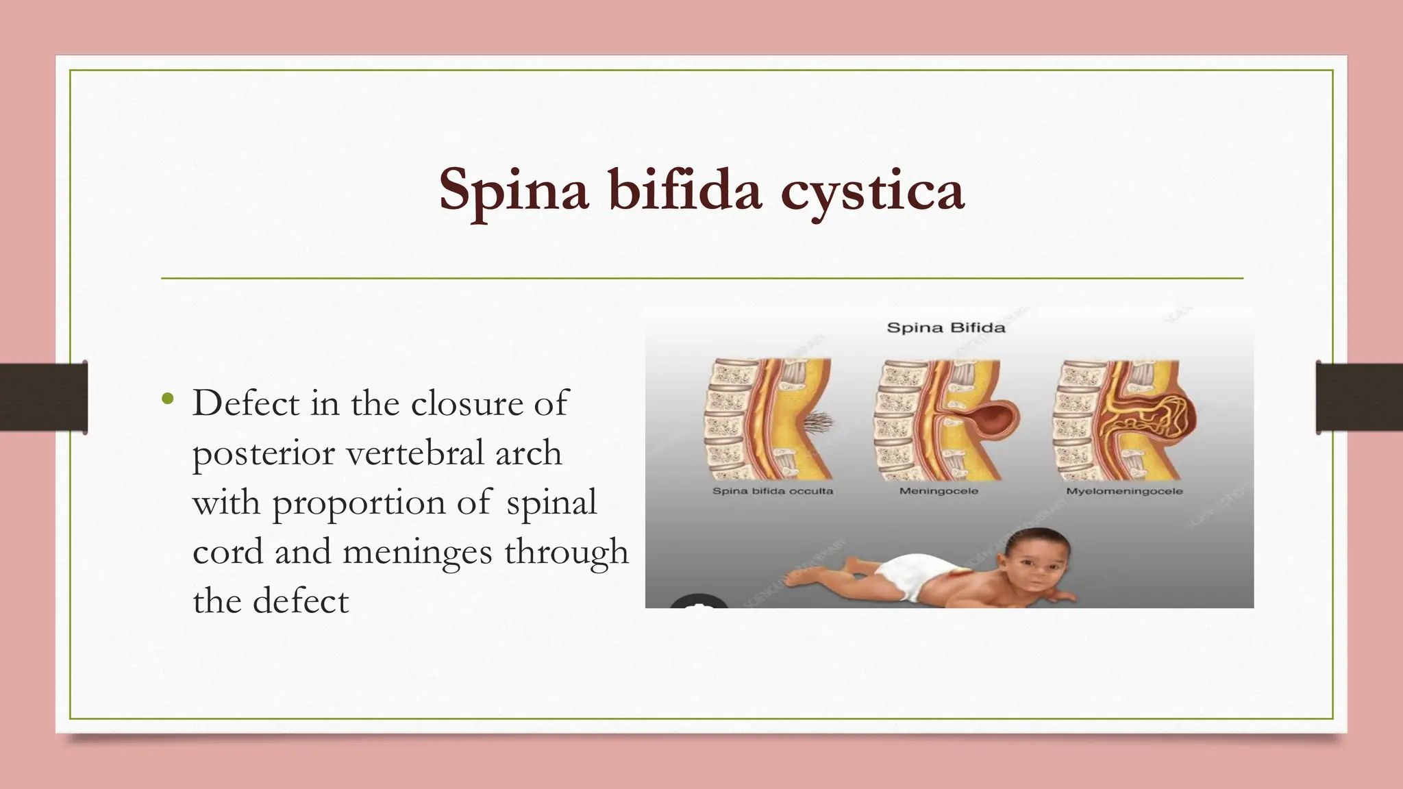 presentation on spinal defects and deformities | PDF