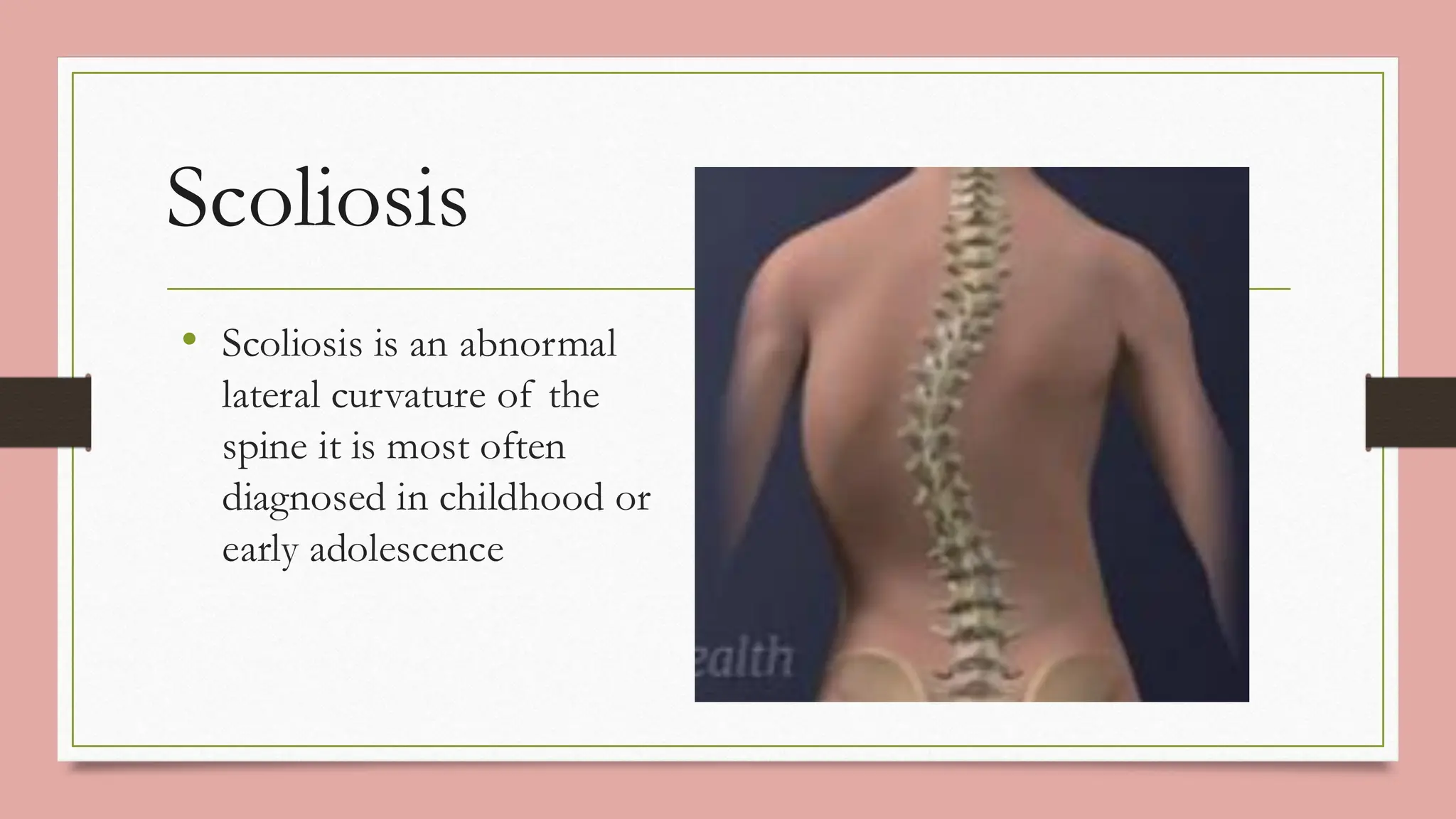 presentation on spinal defects and deformities | PDF | Bone and Joint ...