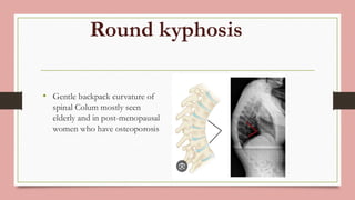 presentation on spinal defects and deformities | PDF