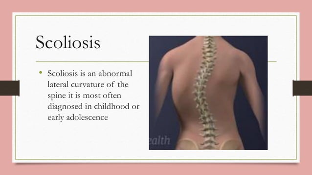 presentation on spinal defects and deformities | PDF | Bone and Joint ...