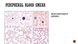 Anemia - concept, approach and treatment | PPTX
