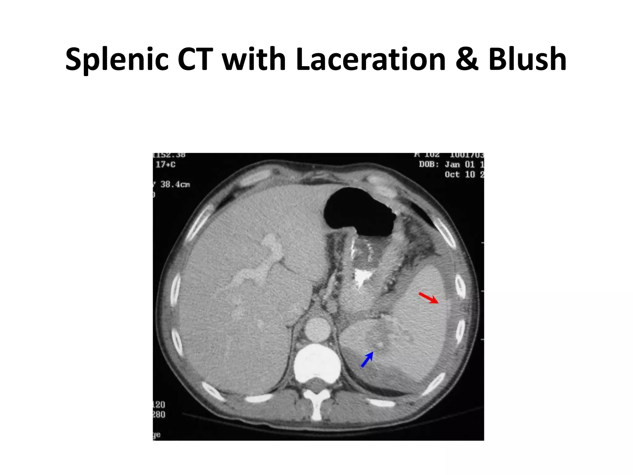 Abdominal-injuries-in-sports.pptx