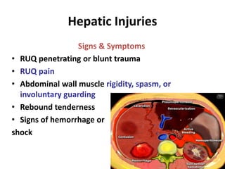 Abdominal-injuries-in-sports.pptx