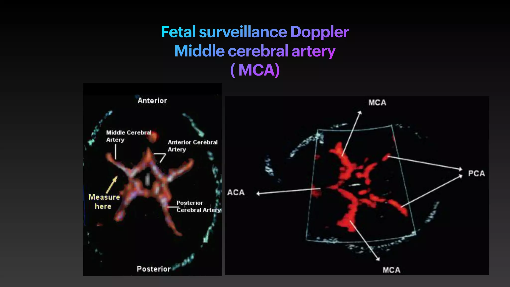 Presentation 11MCA Doppler .pdf
