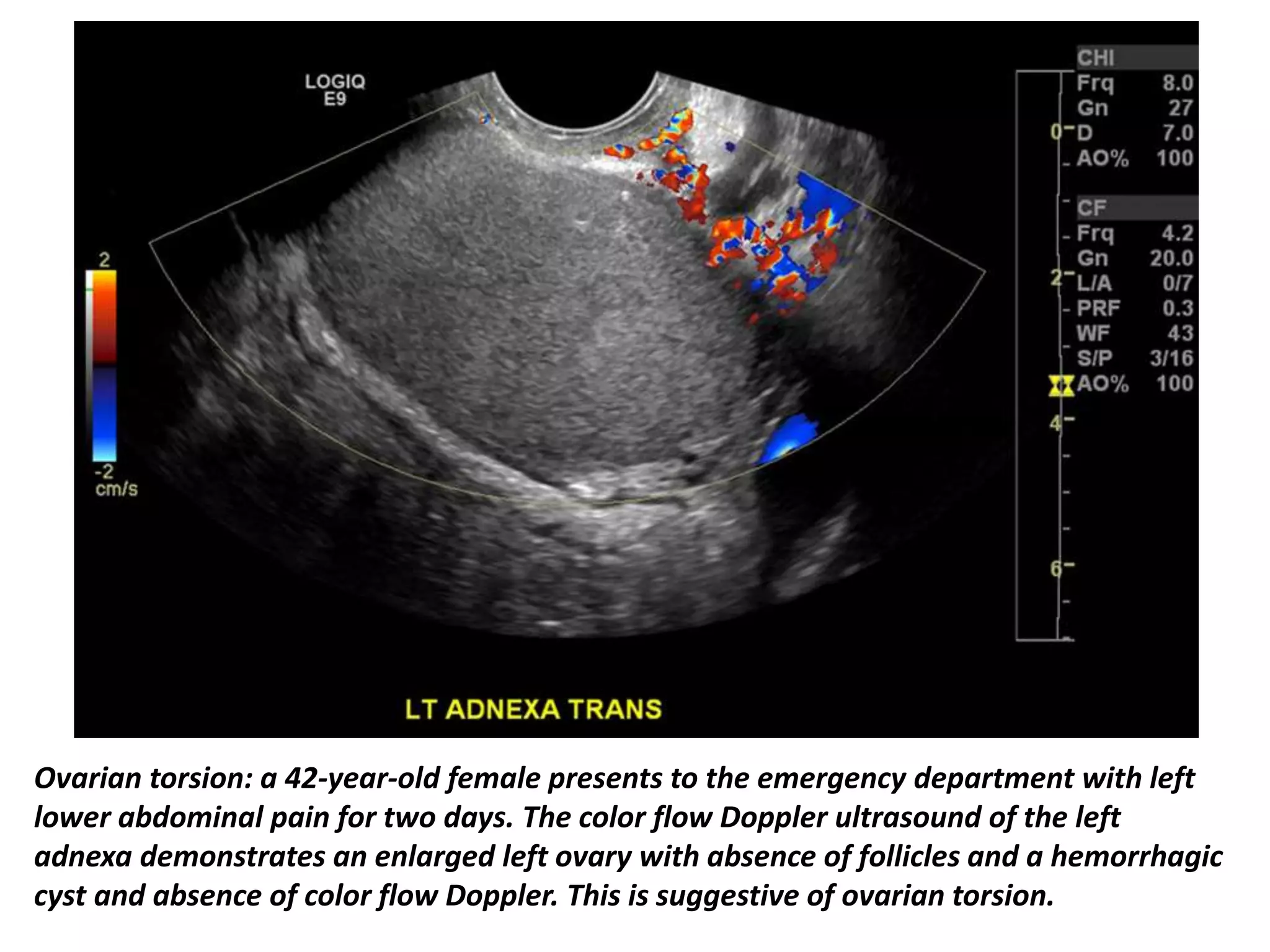 Presentation11, radiological imaging of ovarian torsion. | PPTX