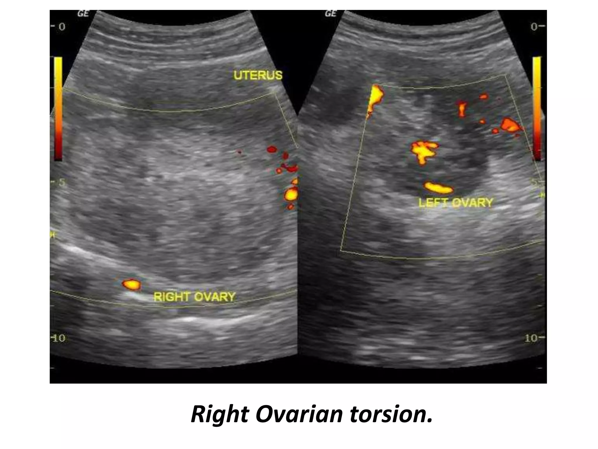 Presentation11, radiological imaging of ovarian torsion. | PPTX