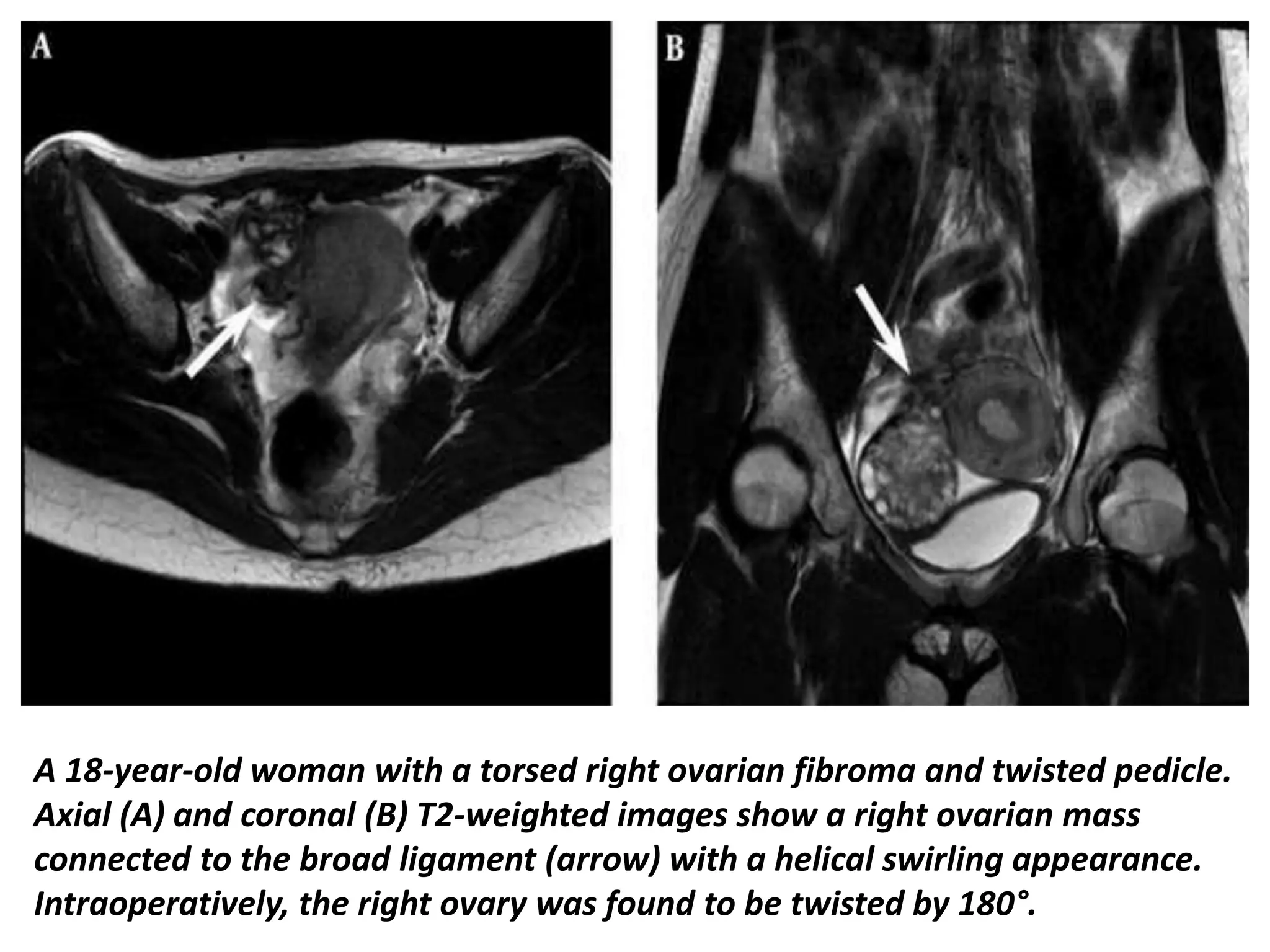 Presentation11, radiological imaging of ovarian torsion. | PPTX