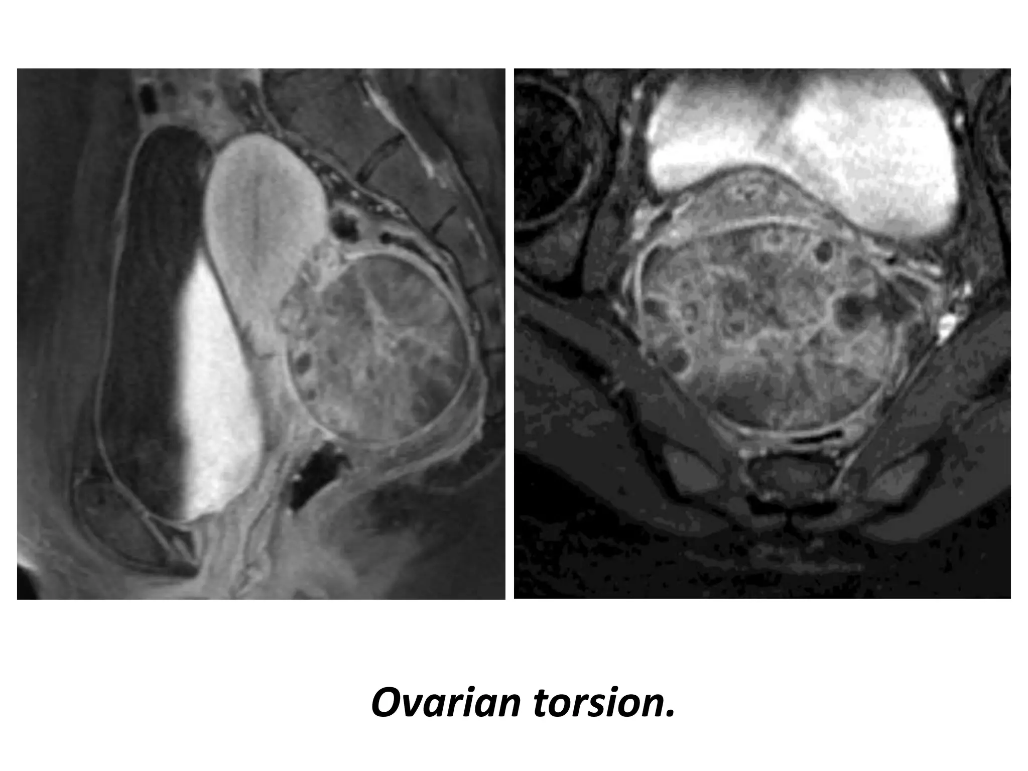 Presentation11, radiological imaging of ovarian torsion. | PPTX