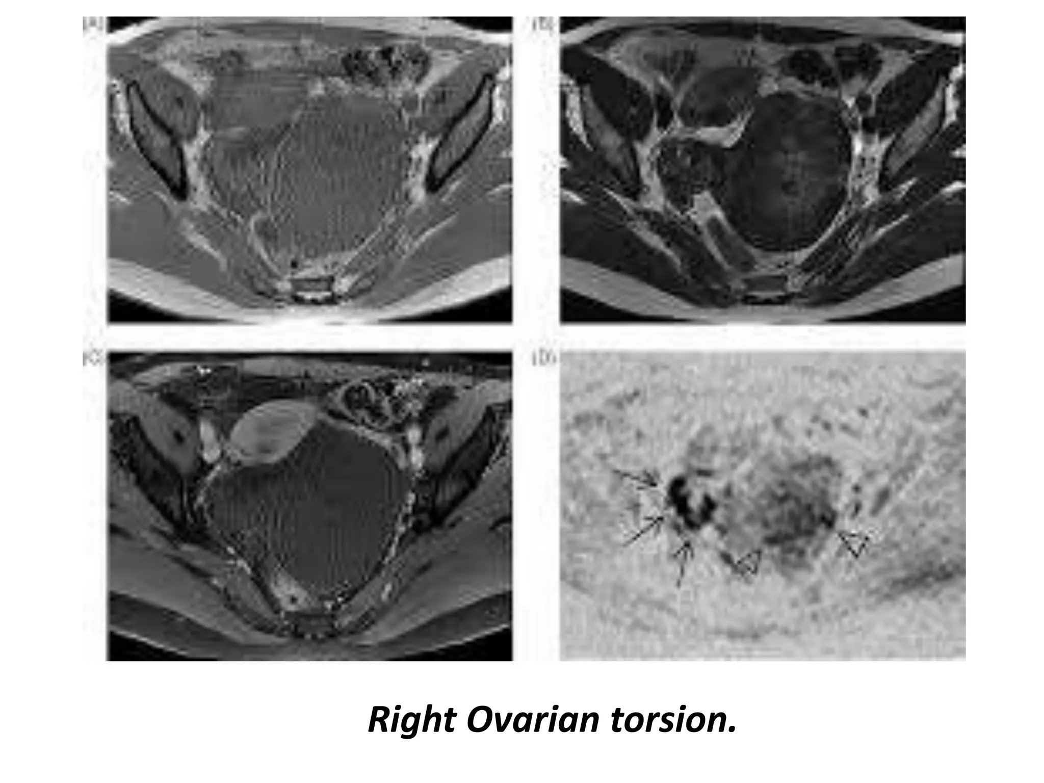 Presentation11, radiological imaging of ovarian torsion. | PPTX